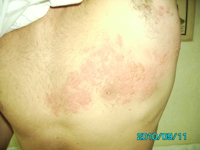 Zona; shingles; zona; zoster